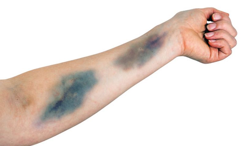 Modrice su opasne kada nastaju iz čista mira: Mogu ukazati na ozbiljne ...