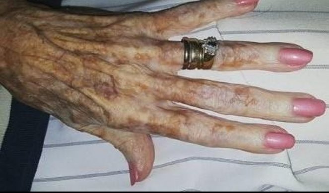 Prvi simptom raka pojavljuje se na rukama, evo kako ga prepoznati | BL ...