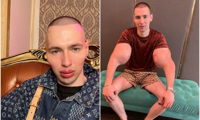 Ruski MMA borac pretjerao: U bicepse sipao ulje, pa operisao facu FOTO ... Ruski MMA borac pretjerao: U bicepse sipao ulje, pa operisao facu FOTO ...