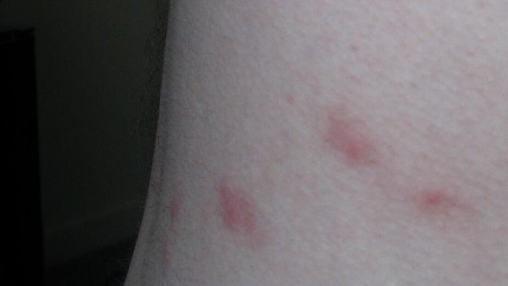 Ujed buve: Kako ga prepoznati, šta smijete, a šta ne smijete da učinite ...